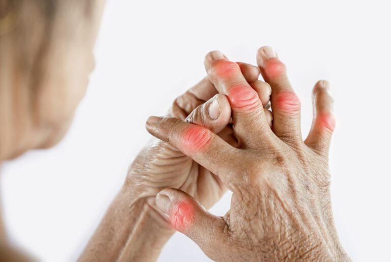 7 Home Remedies to Relieve Arthritis Symptoms - Claudias Concept